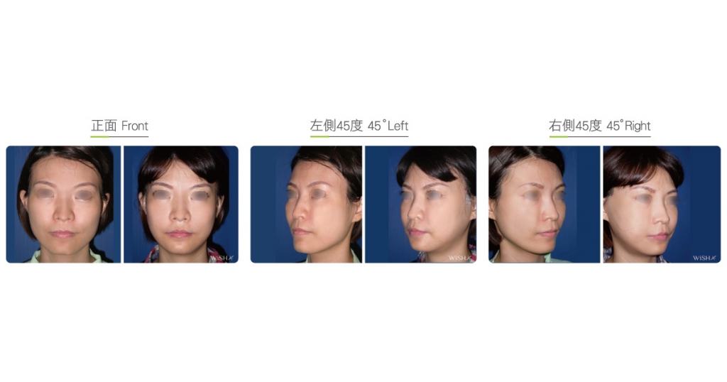 Bone-cheekbone+shaving-f-before-after-05 – 知美整形外科診所
