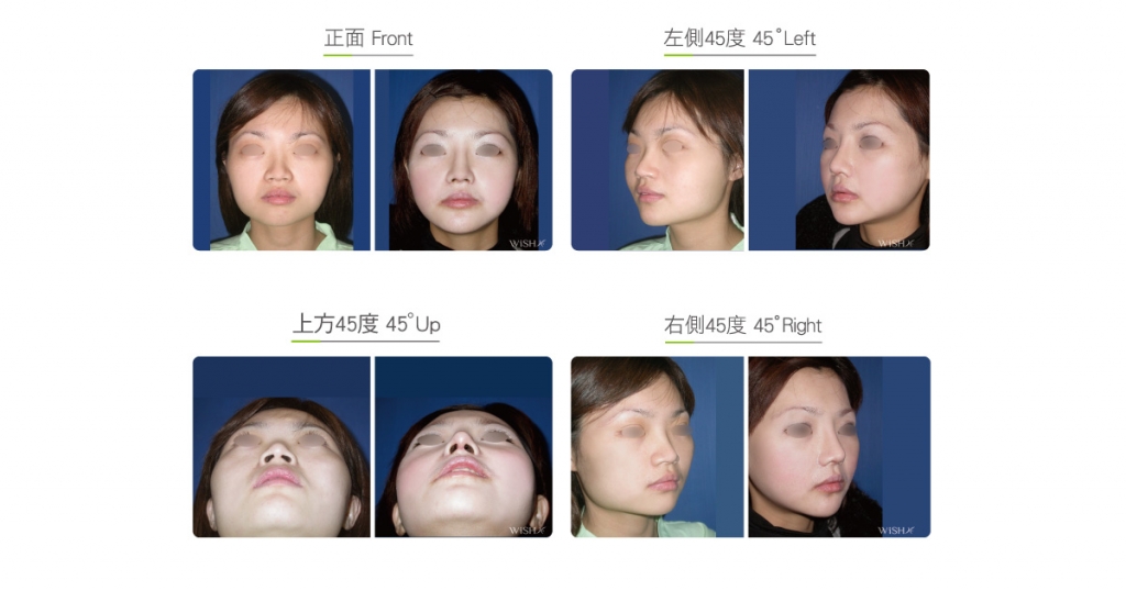 Bone-cheekbone+shaving-f-before-after-11 – 知美整形外科診所