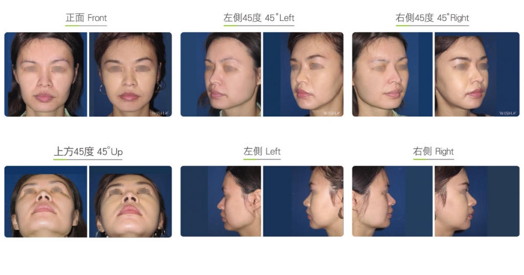 Dental Bone Shaving at Jasper Saranealis blog