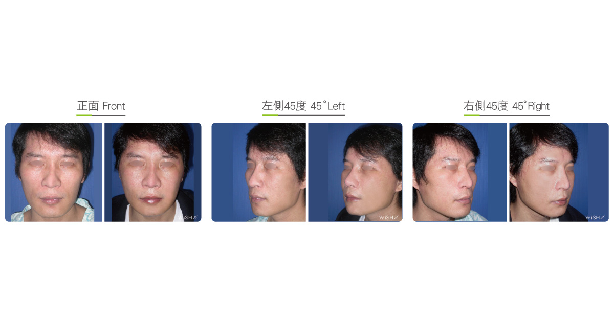 Bone-cheekbone+shavingafteraweek-before-after-01 – 知美整形外科診所