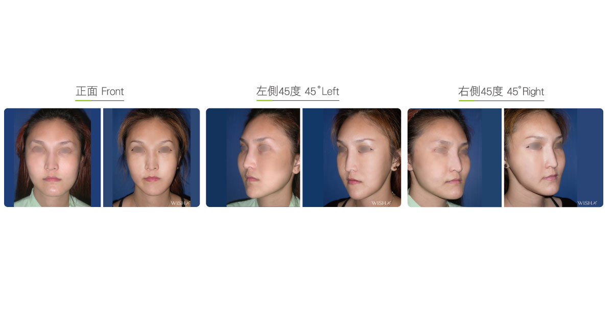 Bone-face-correction-f-before-after-01-5 – 知美整形外科診所