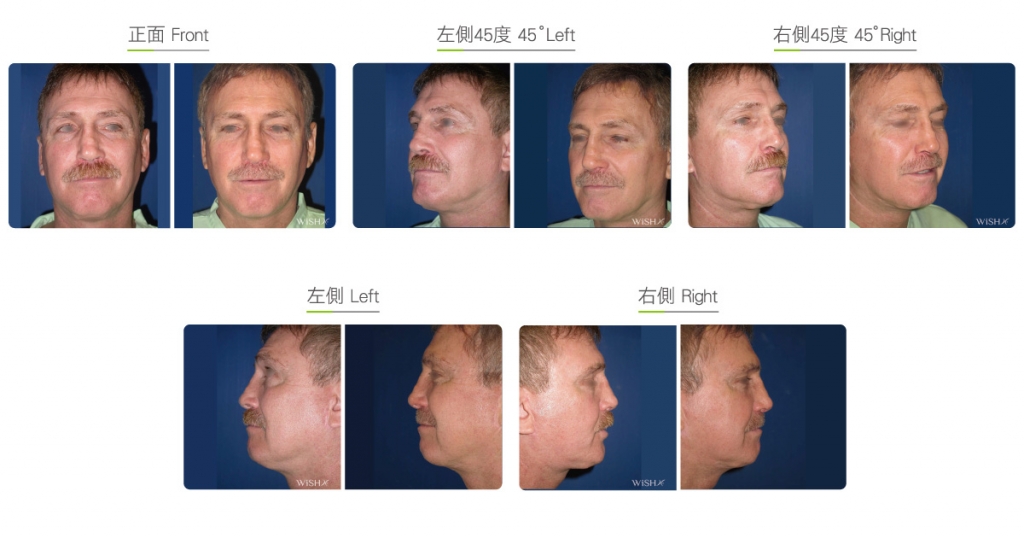 Fat-chin-m-before-after-01 – 知美整形外科診所