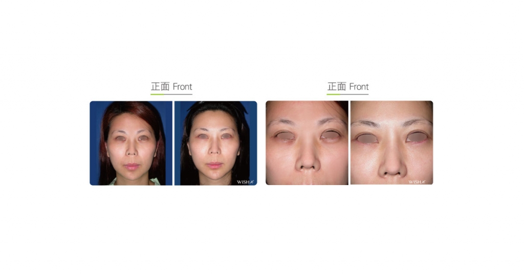 Fat-transfer-Eyes-graft-F-before-after-01 – 知美整形外科診所
