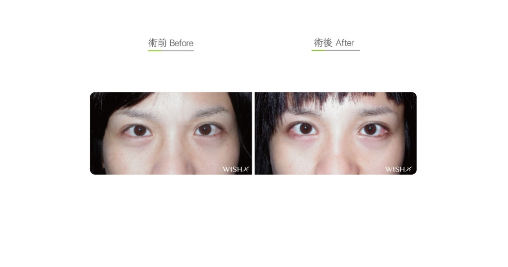 Lateral-canthoplasty-f-before-after-02 – 知美整形外科診所