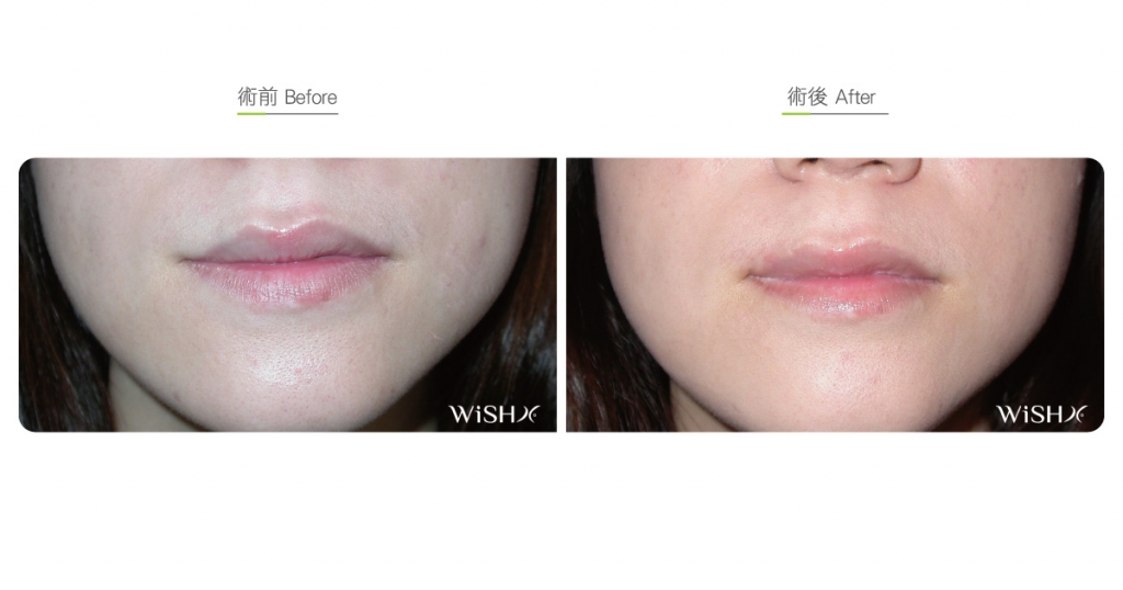 Lip-plasty-m-before-after-01 – 知美整形外科診所