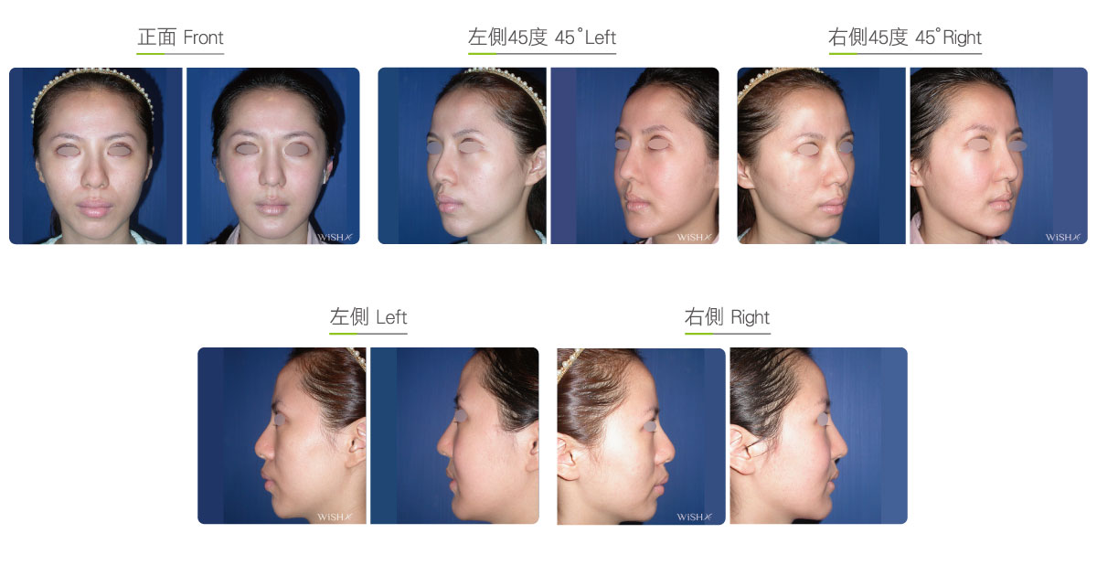 Malar-augmentation-f-before-after-02 – 知美整形外科診所