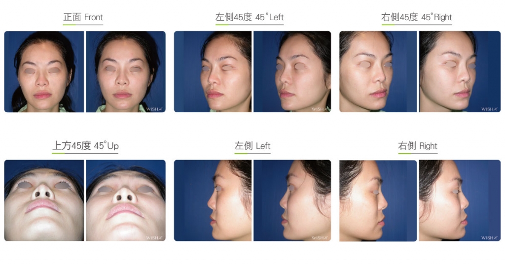 Malar-augmentation-f-before-after-03 – 知美整形外科診所