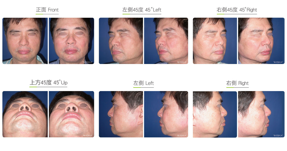 Malar-implant-m-before-after-03-5 – 知美整形外科診所
