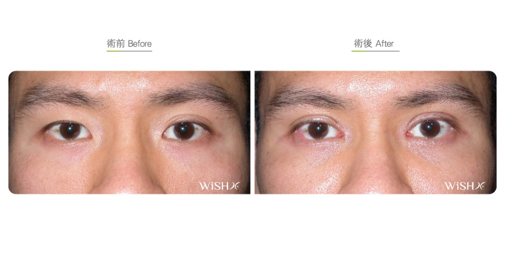 Mini-incision method-M-06-01 – 知美整形外科診所