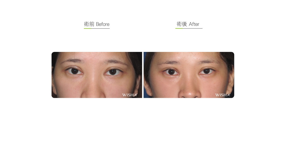 Ptosis-correction-f-before-after-03 – 知美整形外科診所