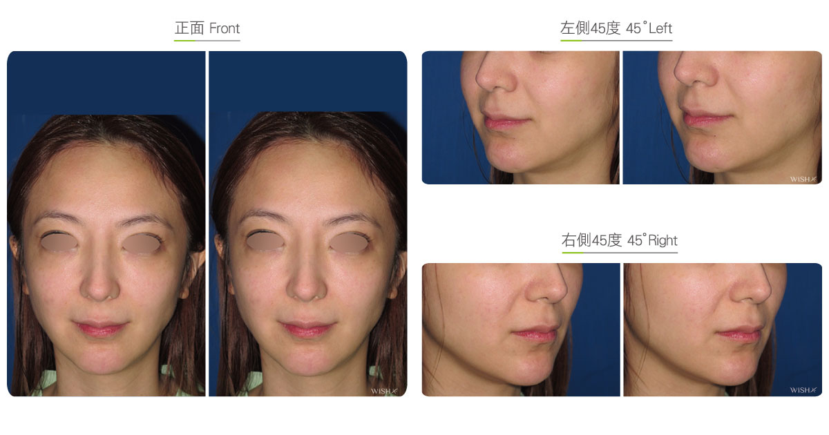 Reduction-before-after-03 – 知美整形外科診所
