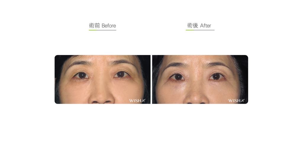 eye-bbb-f-before-after-01 – 知美整形外科診所