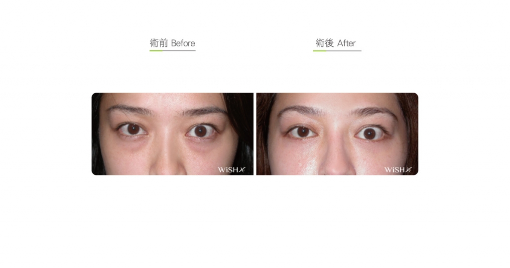 eye-bbb-f-before-after-10 – 知美整形外科診所