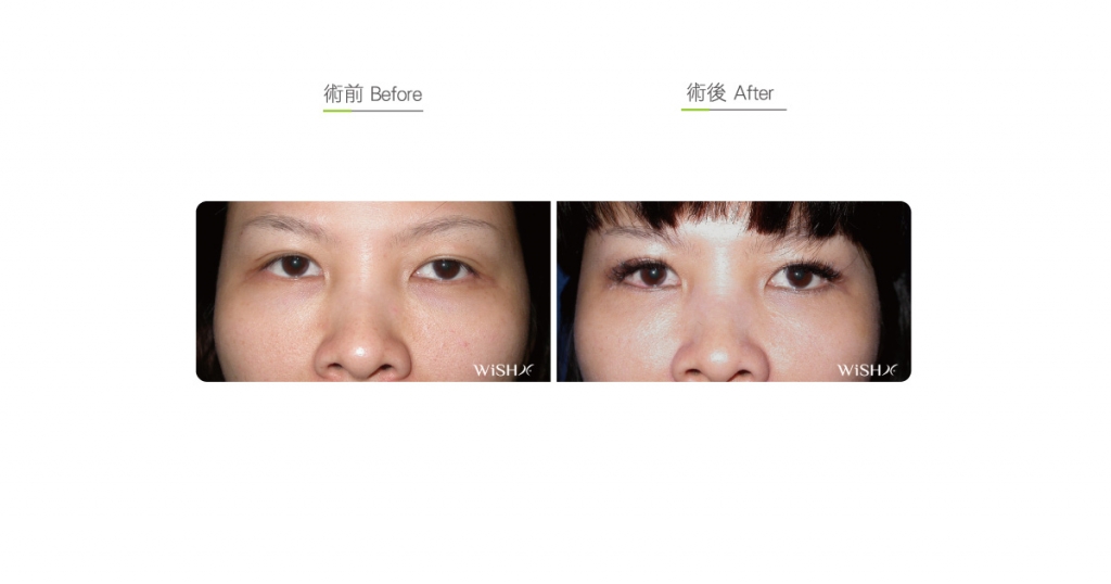 eye-bbb-f-before-after-20 – 知美整形外科診所
